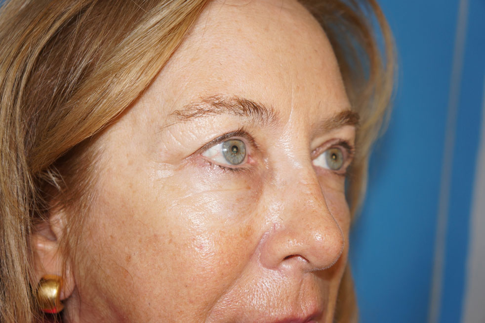 Eyelid Surgery | Daniel Calva-Cerqueira