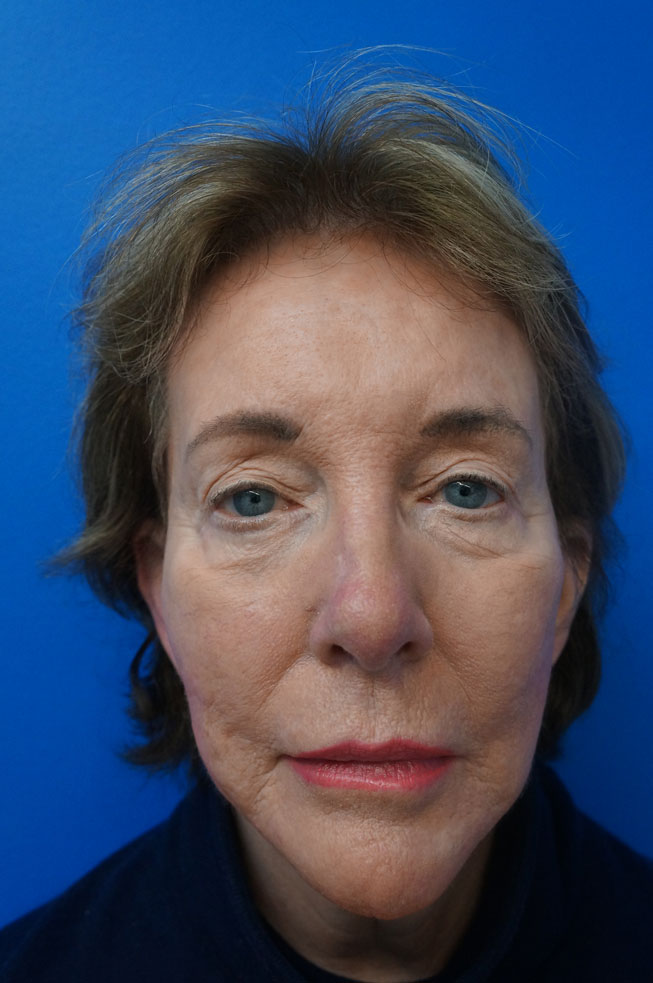 Eyelid Surgery | Daniel Calva-Cerqueira