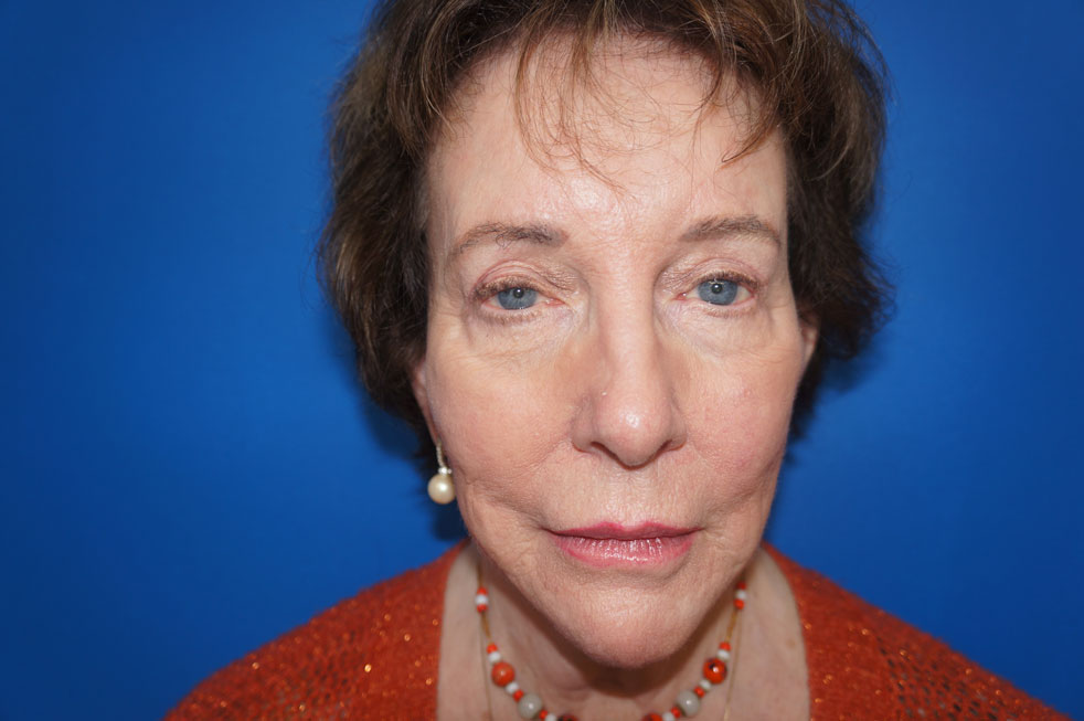 Eyelid Surgery | Daniel Calva-Cerqueira