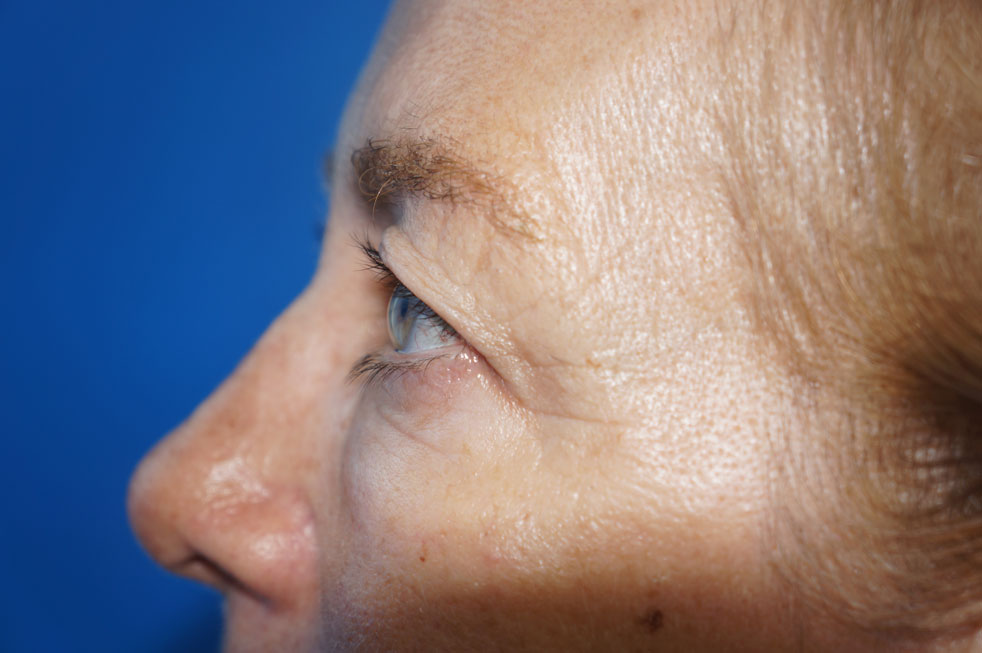 Eyelid Surgery | Daniel Calva-Cerqueira